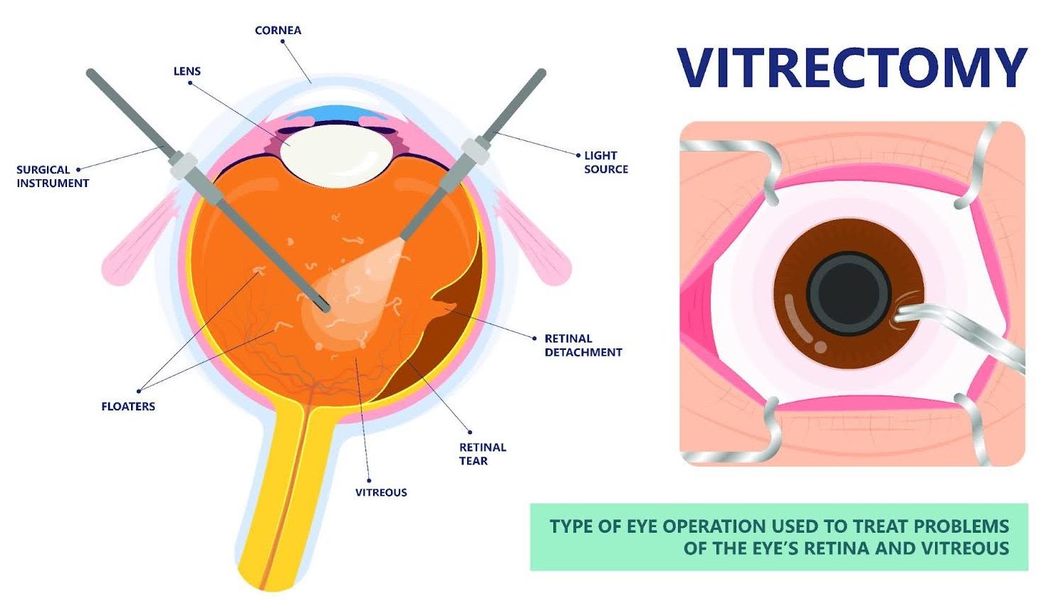 Retinal detachment - Vision For Life