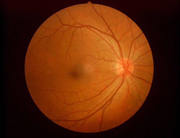 Retinal Vein Occlusion | Vision For Life Institute
