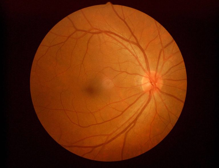 Retinal Vein Occlusion | Vision For Life Institute