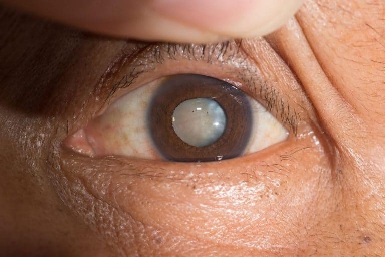 Cataract Surgery Brisbane | Vision for Life Institute